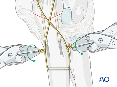 Tension band fixation of olecranon osteotomy
