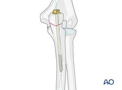 Intramedullary screw fixation of olecranon osteotomy
