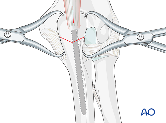 Intramedullary screw fixation of olecranon osteotomy