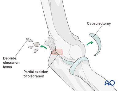 Heterotopic ossification