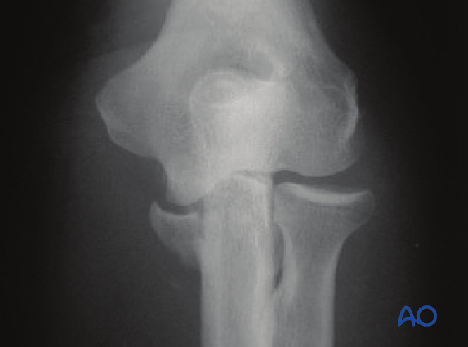 Assessment of elbow stability