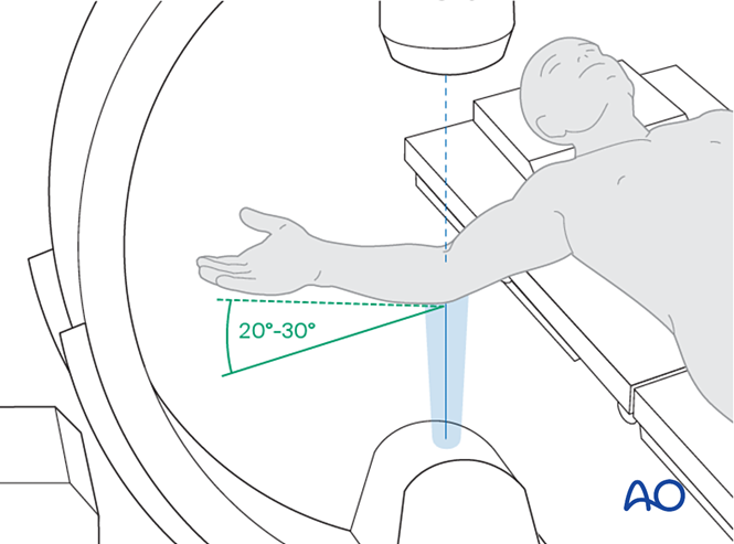 Intraoperative imaging of the distal humerus