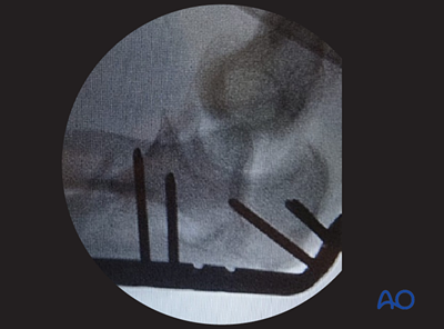 Intraoperative imaging of the distal humerus