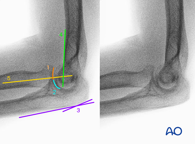 Intraoperative imaging of the proximal forearm