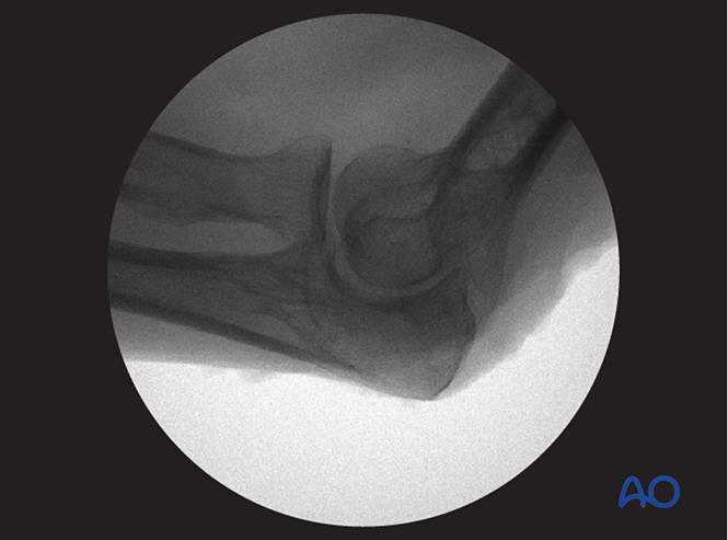 Intraoperative imaging of the distal humerus