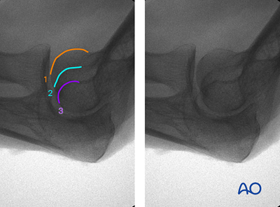 Intraoperative imaging of the distal humerus