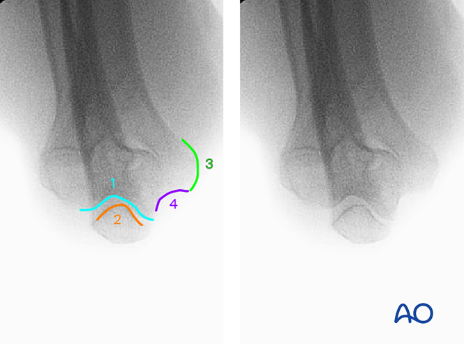 Intraoperative imaging of the distal humerus
