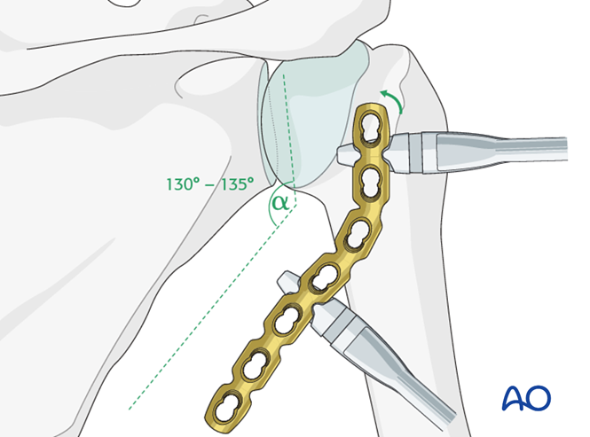 ORIF - Plate fixation for Glenoid fossa, extraarticular, simple