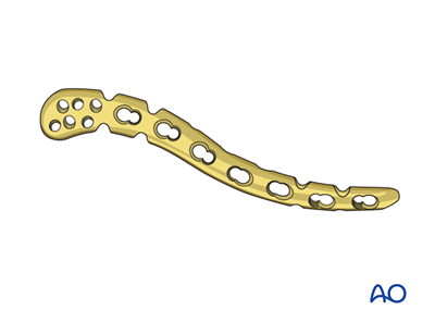 ORIF - Pre-contoured distal plate for Lateral, displaced fracture with ...