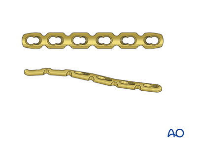 ORIF - Pre-contoured distal plate for Lateral, displaced fracture with ...