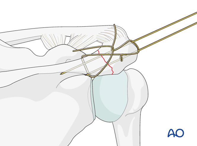 ORIF - Tension band for Body and processes, acromion