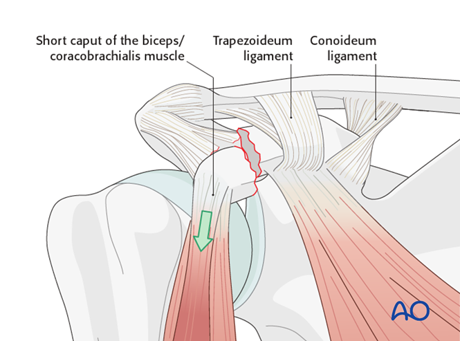 ORIF - Lag screw fixation for Body and processes, coracoid
