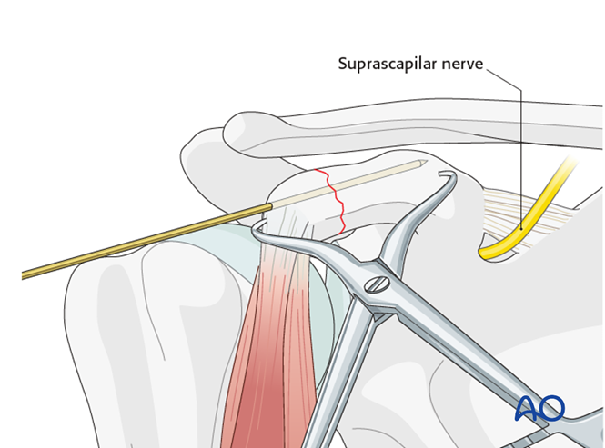 ORIF - Lag screw fixation for Body and processes, coracoid