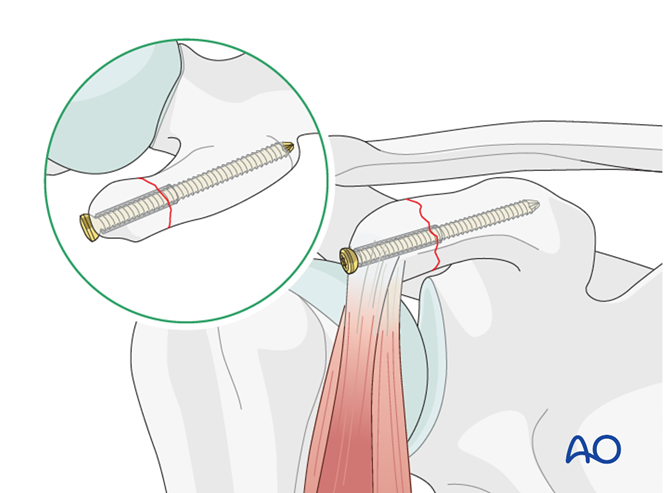 ORIF - Lag screw fixation for Body and processes, coracoid