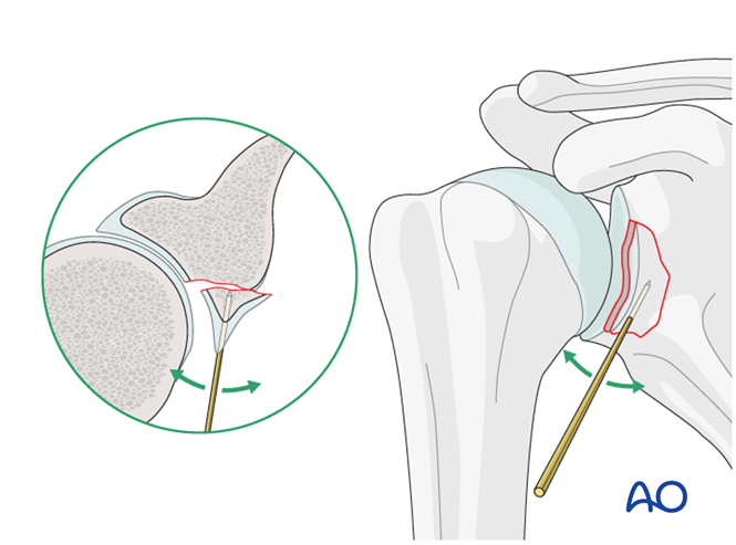 ORIF - Lag screw fixation for Glenoid fossa, partial articular ...