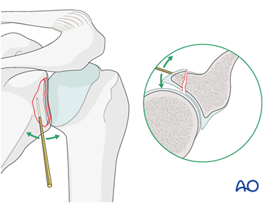 ORIF - Lag screw fixation for Glenoid fossa, partial articular ...