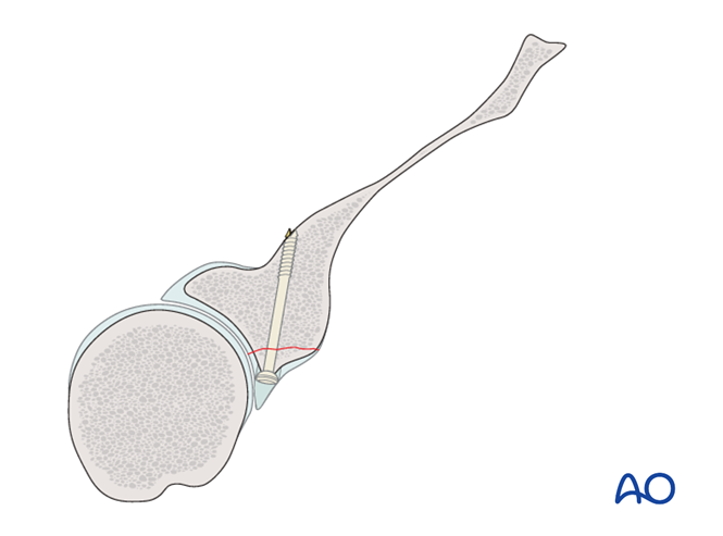 ORIF - Lag screw fixation for Glenoid fossa, partial articular ...