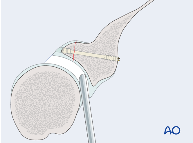 MIO - Lag screw fixation for Glenoid fossa, partial articular ...