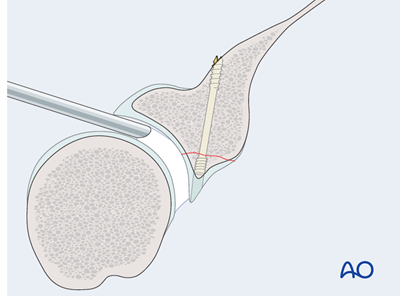 MIO - Lag screw fixation for Glenoid fossa, partial articular ...