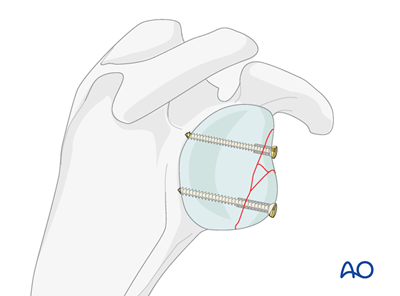 ORIF - Lag screw fixation for Glenoid fossa, partial articular ...