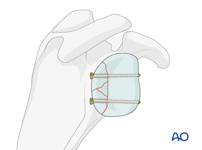 ORIF - Lag screw fixation for Glenoid fossa, partial articular ...