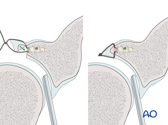 ORIF - Suture anchors for Glenoid fossa, partial articular, posterior ...