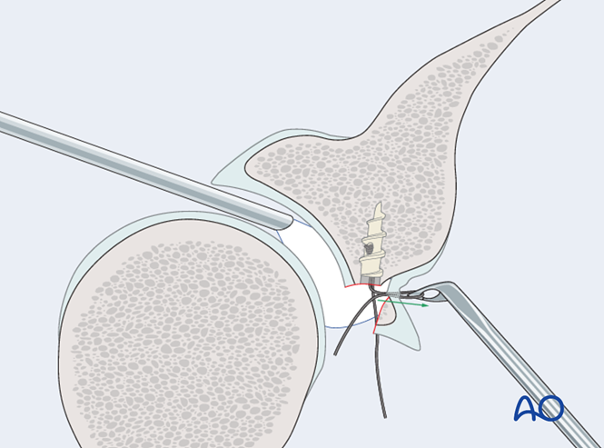 ORIF - Suture anchors for Glenoid fossa, partial articular, anterior simple