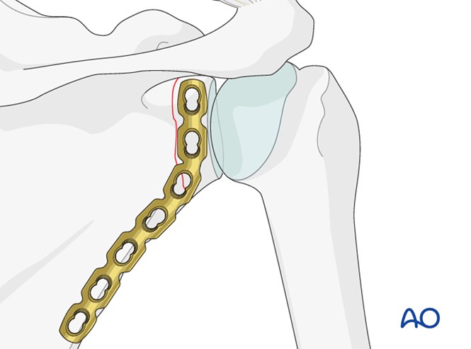 ORIF - Plate fixation for Glenoid fossa, extraarticular, simple