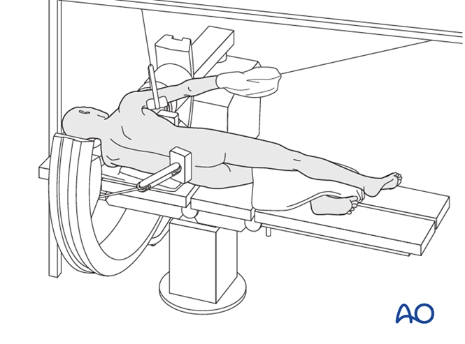 Floating shoulder - Sequence of repair