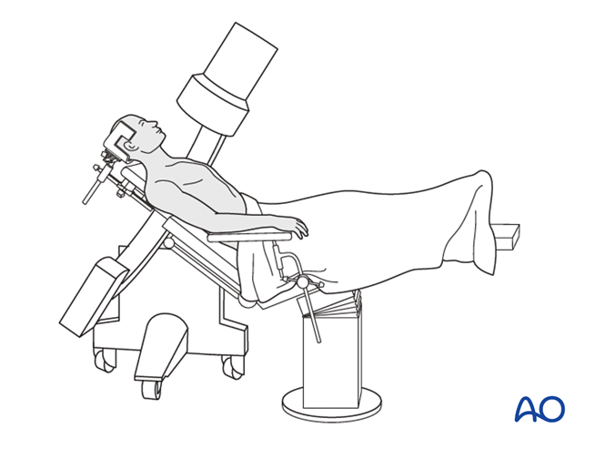 ORIF - Lag screw fixation for Body and processes, coracoid