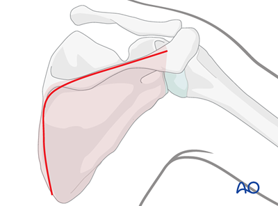 Posterior approach to the scapular body