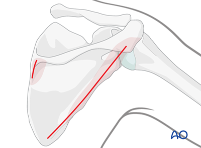 Posterior approach to the scapular body