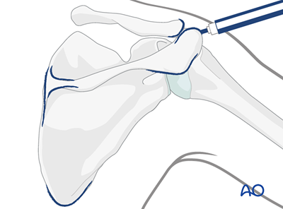 Posterior approach to the scapular body