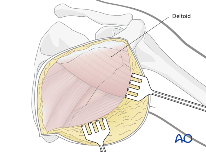 Posterior approach to the scapular body