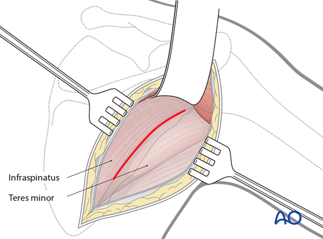 Posterior approach to the scapular body