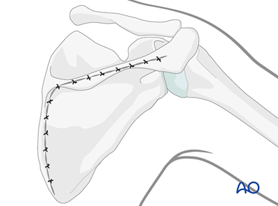 Posterior approach to the scapular body