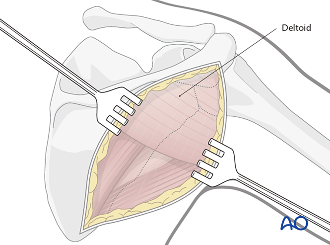 Posterior approach to the scapular body