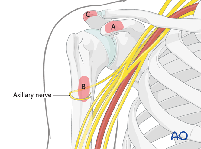 Deltopectoral approach to the scapula
