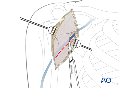 Deltopectoral approach to the scapula