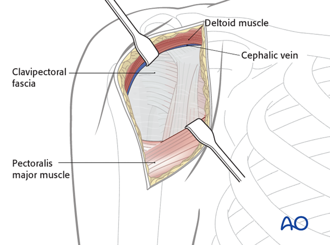 Deltopectoral approach to the scapula