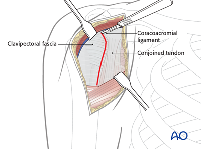 Deltopectoral approach to the scapula