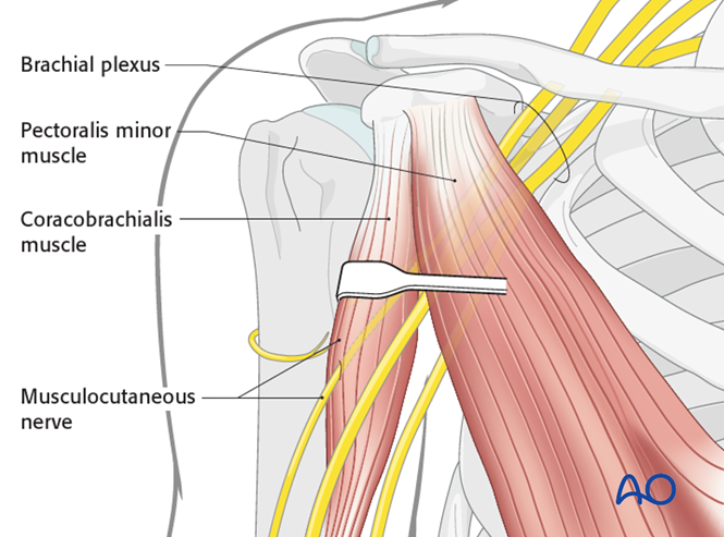 Deltopectoral approach to the scapula