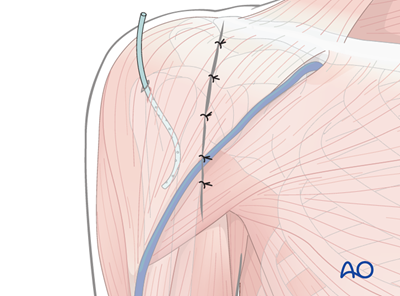 Deltopectoral approach to the scapula