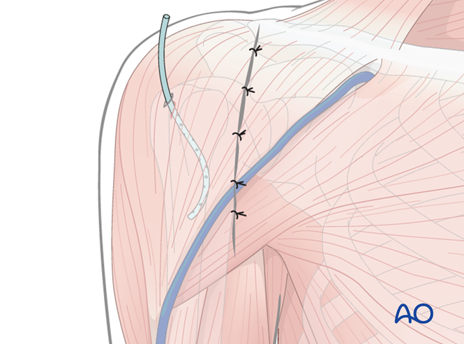 Deltopectoral approach to the scapula