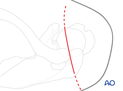 Sabercut approach to the scapula