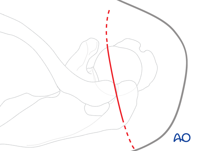 Sabercut approach to the scapula