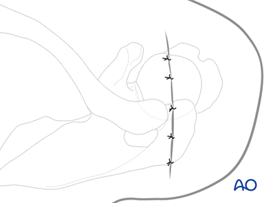 Sabercut approach to the scapula