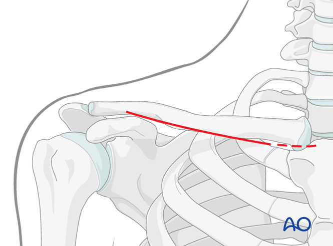 Anterior approach to the clavicle