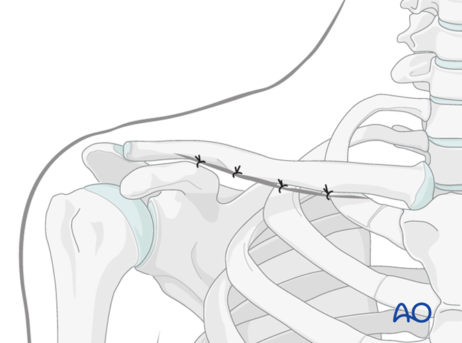 Anterior approach to the clavicle
