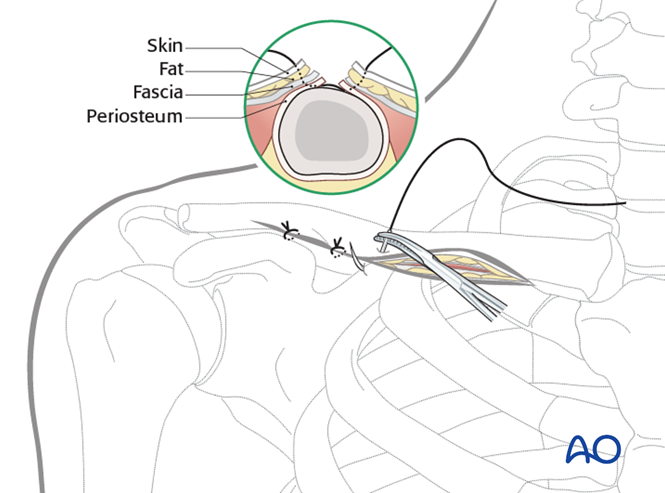 Anterior approach to the clavicle